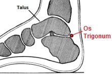 Os Trigonum Syndrome: Causes, Symptoms & Treatment