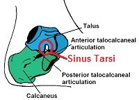 Sinus Tarsi Syndrome: Symptoms, Causes & Treatment