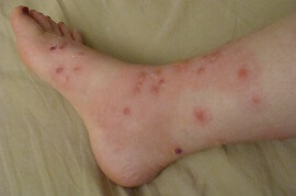 Foot Rash: Causes, Symptoms & Treatment