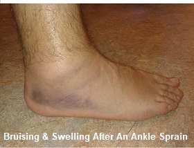 Pain On Outside Of Foot: Symptoms, Diagnosis & Treatment