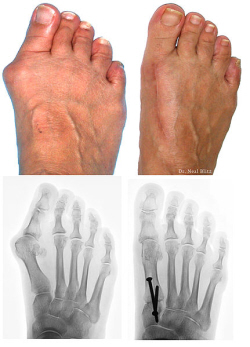 Bunion Surgery Recovery: What To Expect After Bunion Surgery