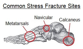 Pain On Outside Of Foot: Symptoms, Diagnosis & Treatment