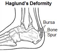 Haglunds Deformity: Causes, Symptoms & Treatment