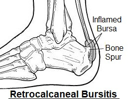 Heel Pain Causes, Symptoms & Treatment - Foot Pain Explored