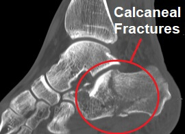 Heel Pain Causes, Symptoms & Treatment - Foot Pain Explored