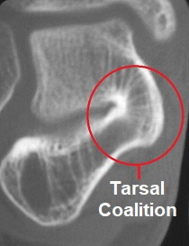 Pain on Top of Foot: Causes, Symptoms & Treatment