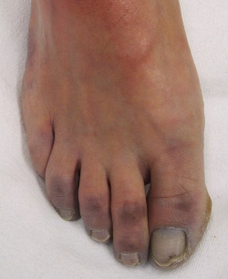 Blue Toe Syndrome: Symptoms, Causes & Treatment