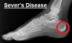 Heel Pain Causes, Symptoms & Treatment - Foot Pain Explored