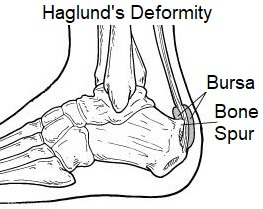 Haglunds Deformity: Causes, Symptoms & Treatment