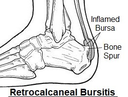 Retrocalcaneal Bursitis: Symptoms, Causes & Treatment