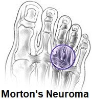 Toe Joint Pain: 10 Common Causes